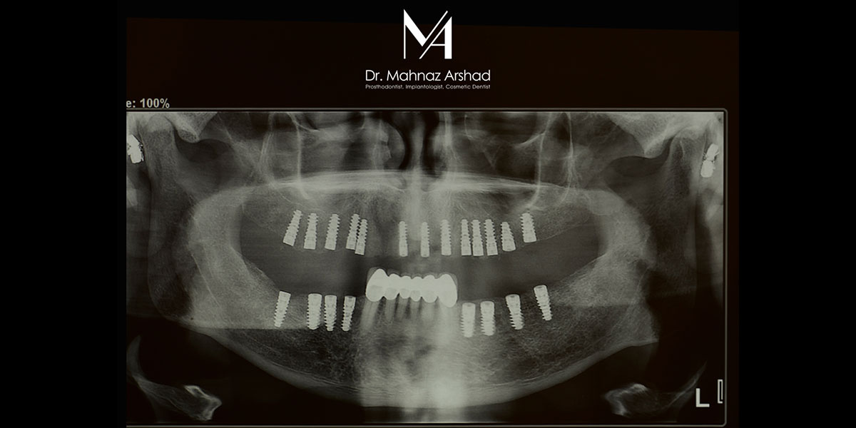 عکس CBCT دندان چیست و چه زمانی نیاز است؟ - دکتر مهناز ارشد