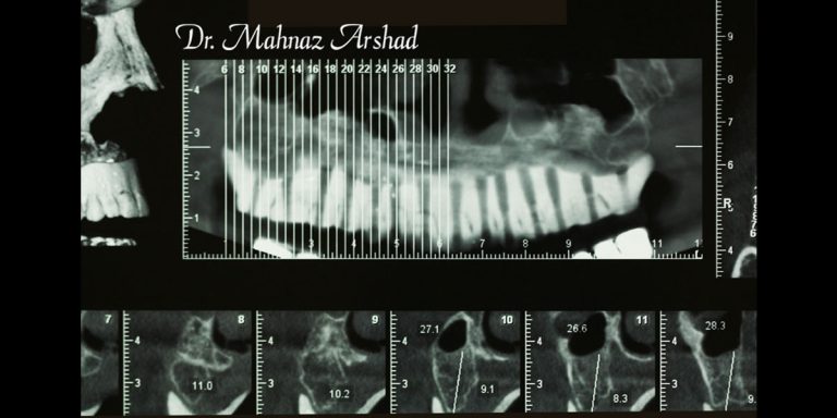 عکس CBCT دندان چیست و چه زمانی نیاز است؟ - دکتر مهناز ارشد